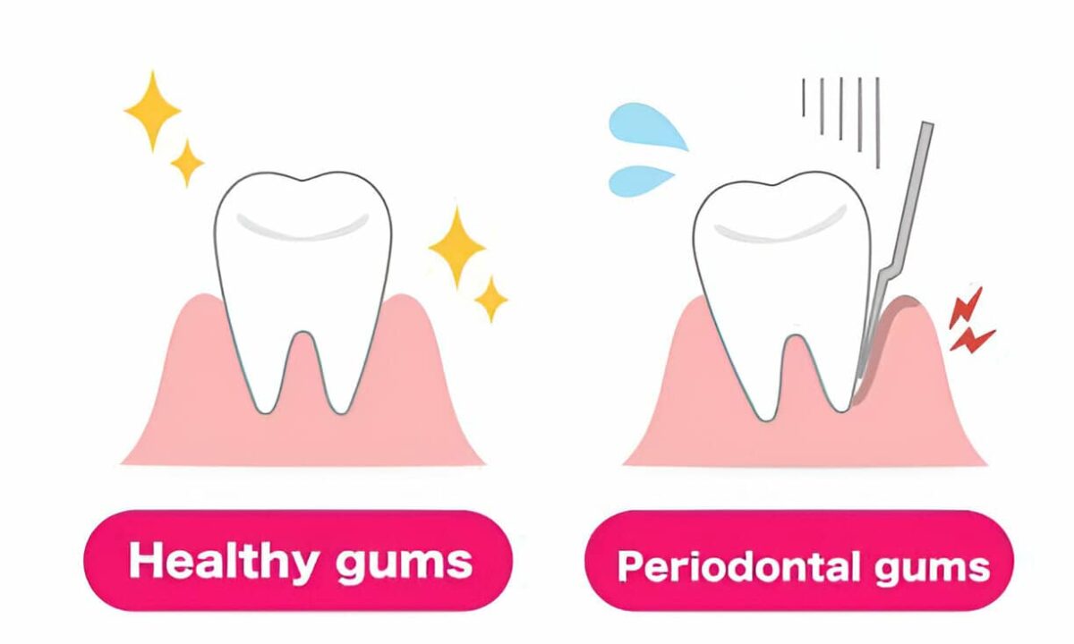 Common Signs You Might Need to See a Periodontist